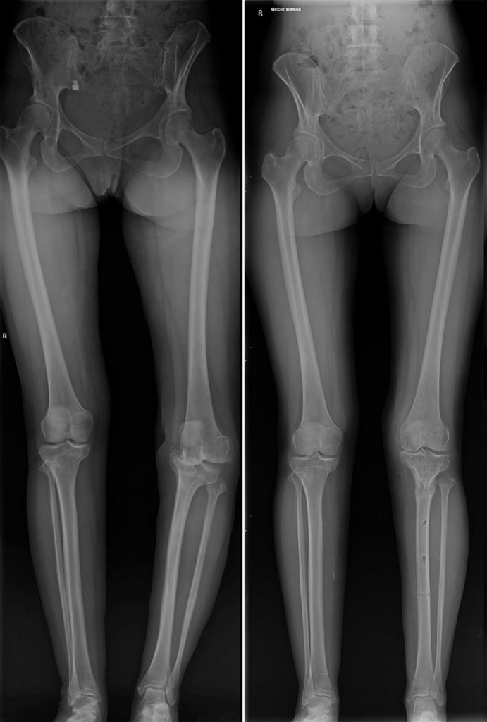 Gradual Deformity Correction with External Fixation | CLLC Montréal ...