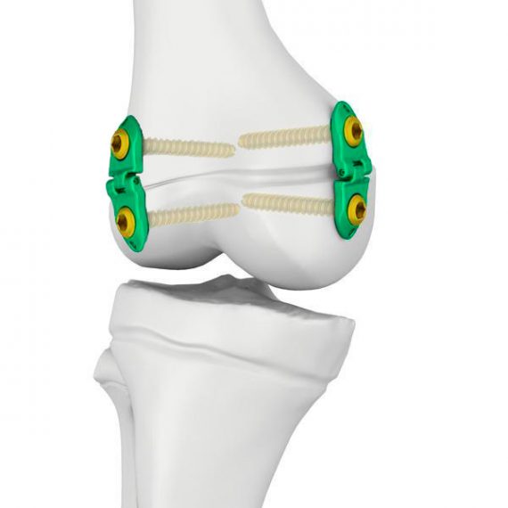 Epiphysiodesis and Hemiepiphysiodesis | CLLC Montréal, Dre Marie Gdalevitch