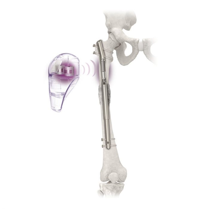 Cosmetic Height Lengthening, CLLC Montreal, Dr Marie Gdalevitch