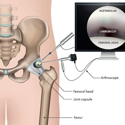 Arthroscopie de la hanche, déchirure labrale Montréal, Quebec