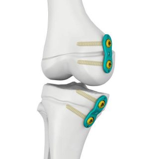 Epiphysiodesis and Hemiepiphysiodesis | CLLC Montréal, Dre Marie Gdalevitch
