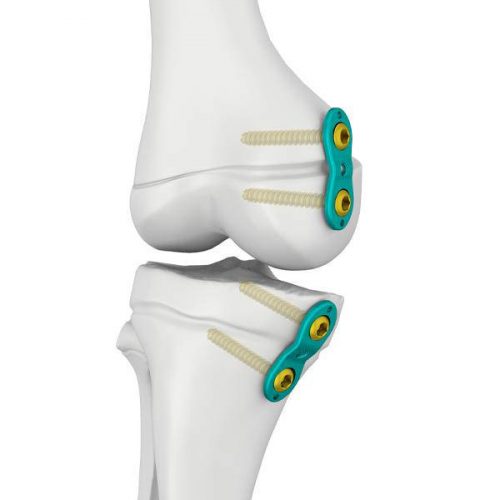Epiphysiodesis and Hemiepiphysiodesis | CLLC Montréal, Dre Marie Gdalevitch