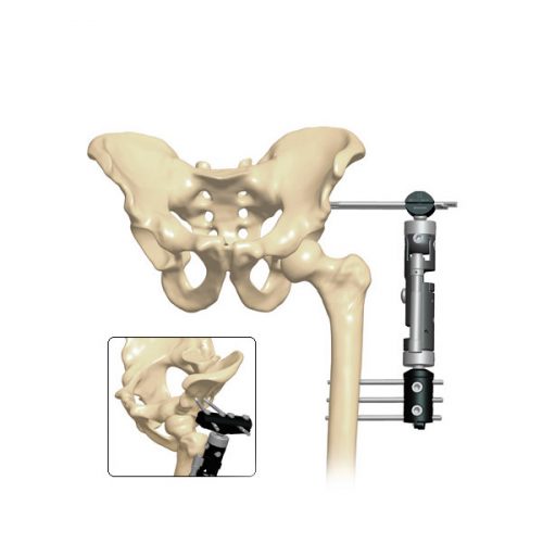 Articulated Hip distraction | CLLC Montréal, Dre Marie Gdalevitch