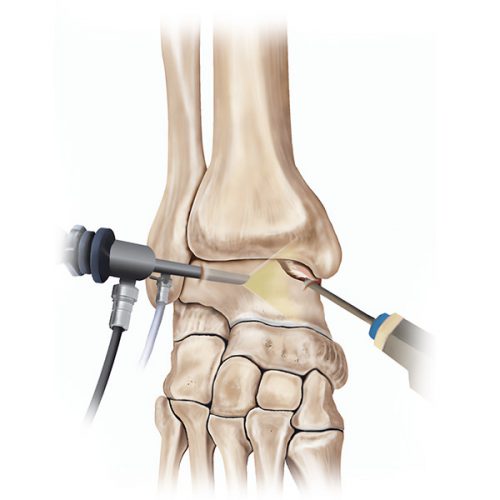 Ankle arthroscopy | CLLC Montréal, Dre Marie Gdalevitch