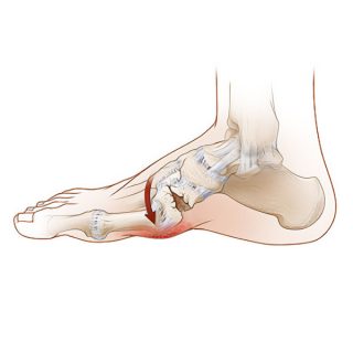 Charcot foot | CLLC Montréal, Dre Marie Gdalevitch