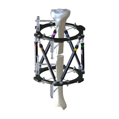 Gradual Limb Lengthening with External Fixation | CLLC Montréal, Dre ...