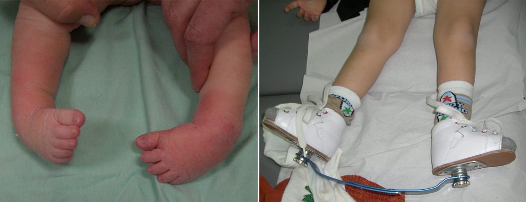 Technique de Ponseti pour les pieds bots | CLLC Montréal, Dre Marie Gdalevitch