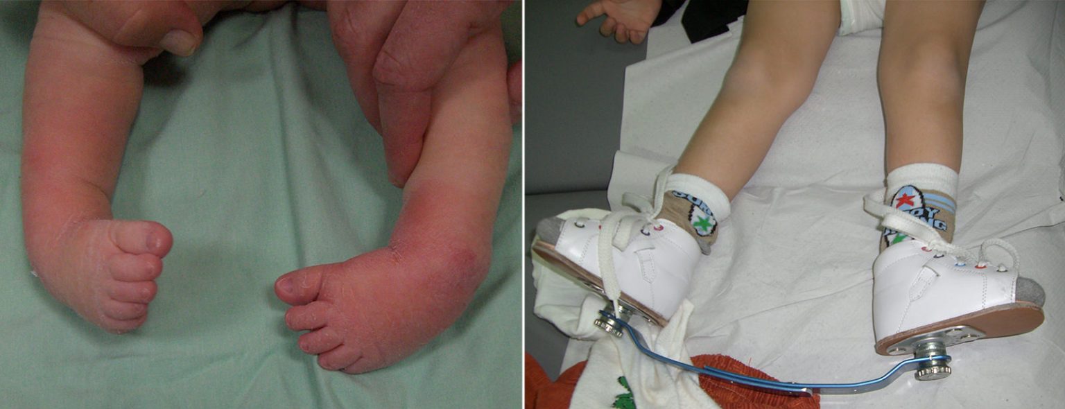 Ponseti casting for baby foot deformities | CLLC Montréal, Dre Marie ...