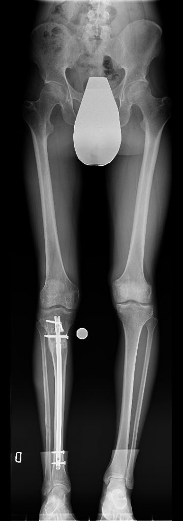 Gradual Limb Lengthening with External Fixation | CLLC Montréal, Dre ...