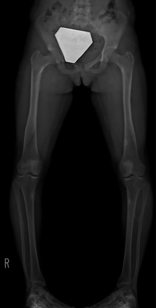 17 year old girl with rickets | CLLC Montréal, Dre Marie Gdalevitch