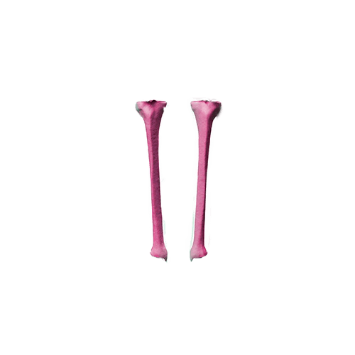 Periosteal grafting for congenital pseudarthrosis of tibia | CLLC ...