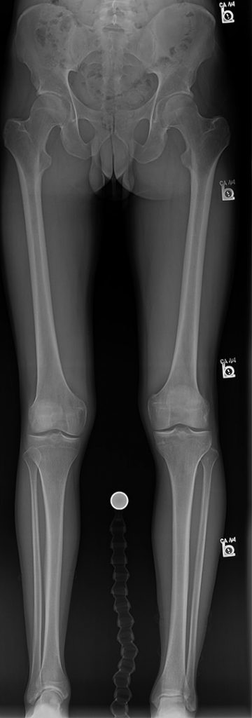Gradual Limb Lengthening with External Fixation | CLLC Montréal, Dre ...