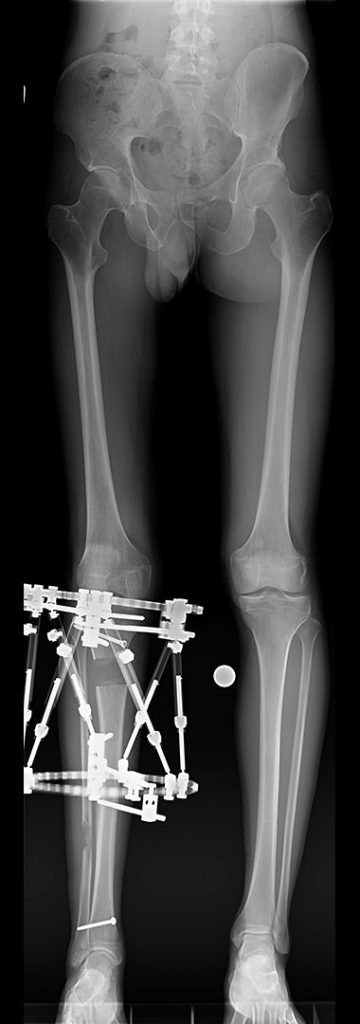 Gradual Limb Lengthening with External Fixation | CLLC Montréal, Dre ...